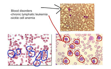 Blood Disorders | Educreations